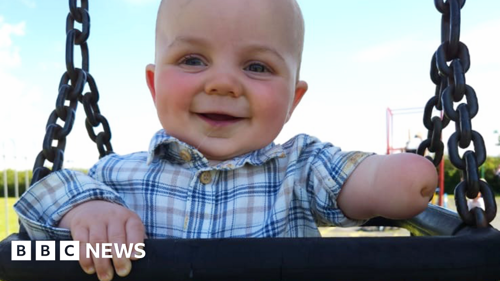 Disability: Support delight for parents of baby with missing limb - BBC ...