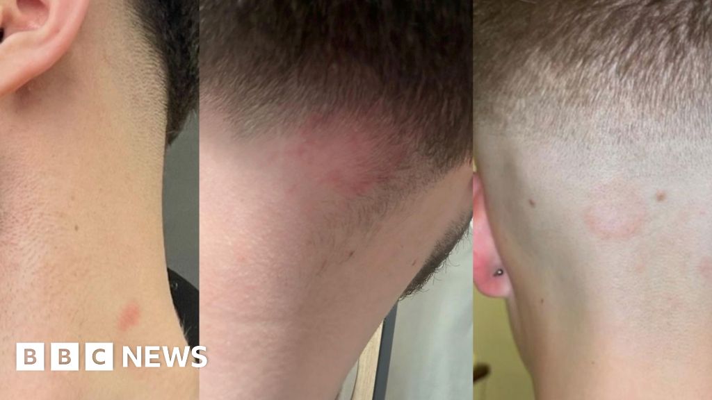 Skin fade warning over ringworm caught at barbers - BBC News