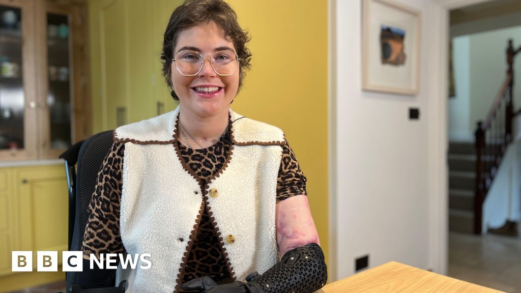 Sepsis amputee Lily McGarry returns home to Jersey