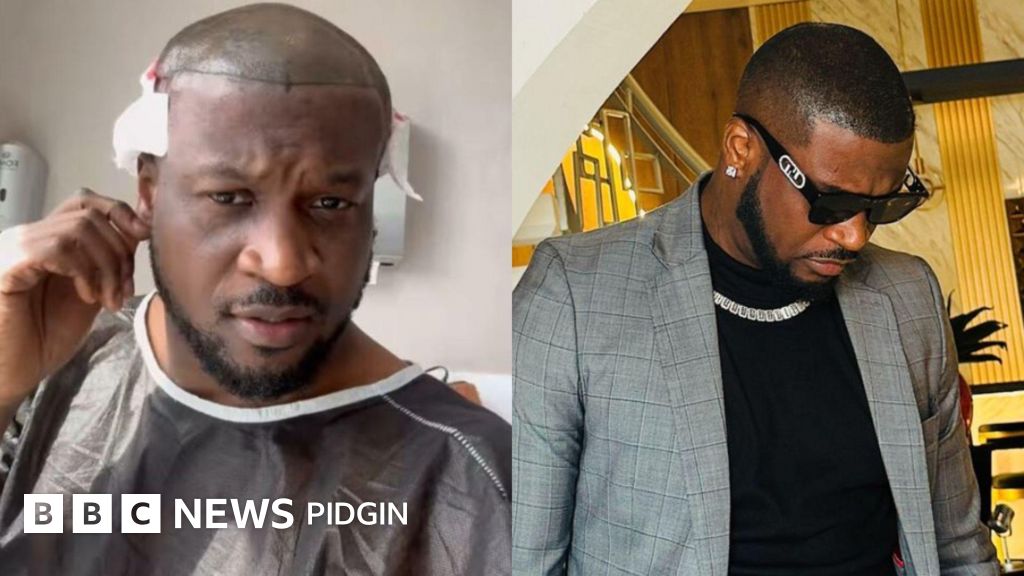 Hair transplant: Cost, surgery side effects plus oda tins to know about ...