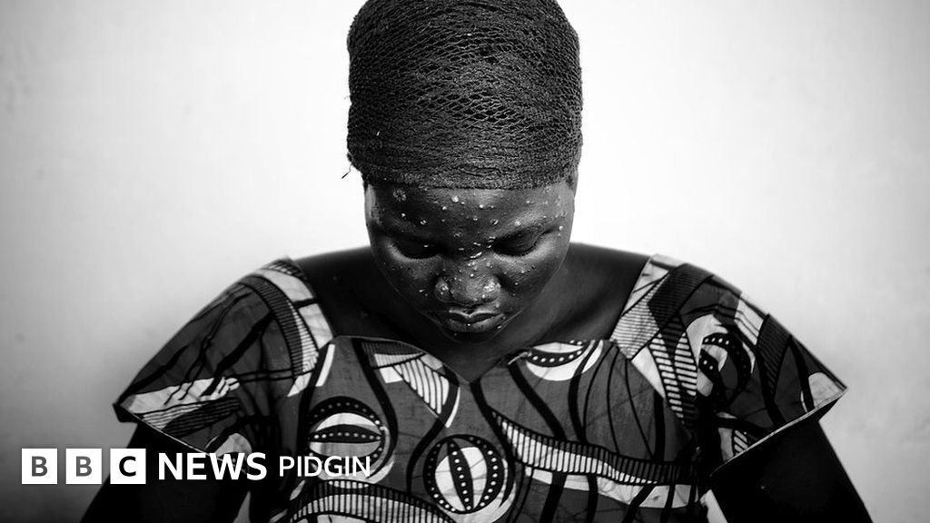 Monkeypox cases dey investigated in Europe, US, Canada - BBC News Pidgin