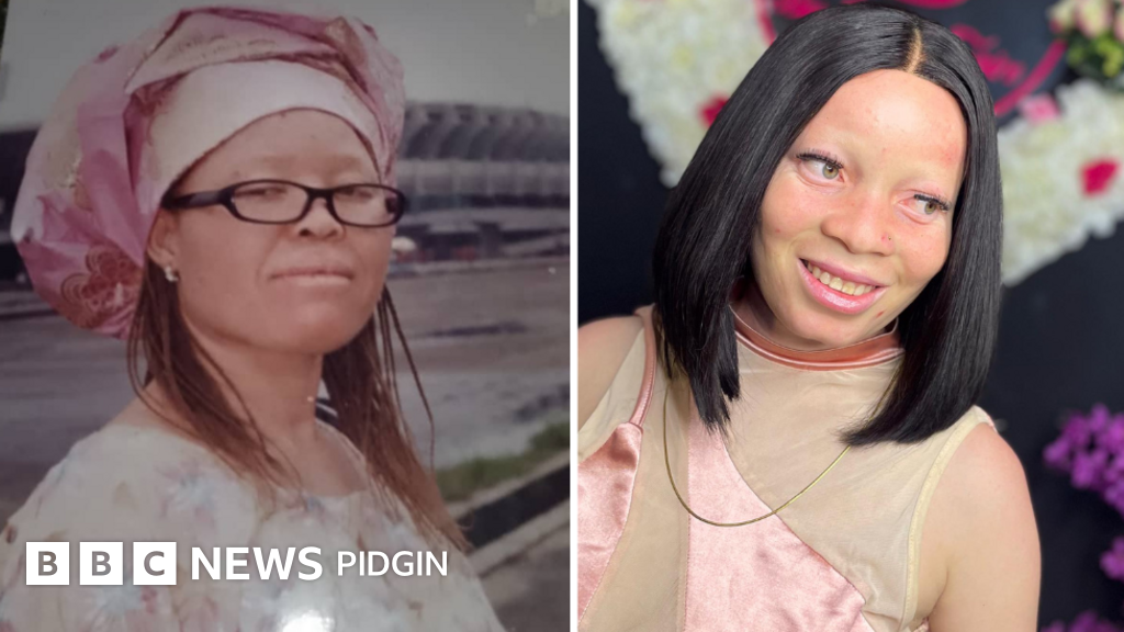 Albinism: Palava wey women wit di condition dey face for relationship ...