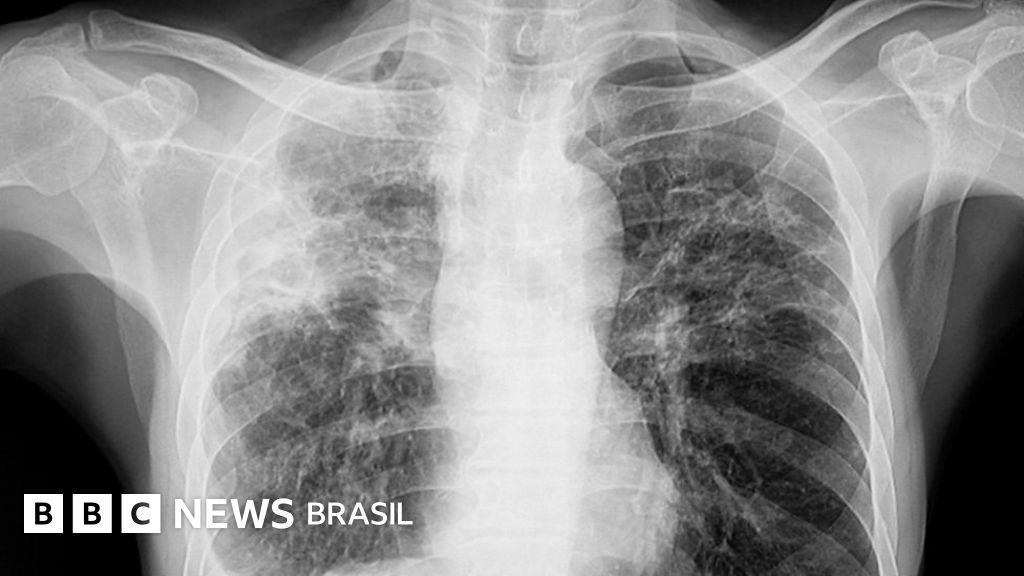 Tuberculose pulmonar ultrapassa fronteiras de presídios e favelas no Brasil - BBC News Brasil