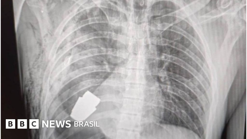 Médicos retiram granada não detonada alojada perto de coração de ...