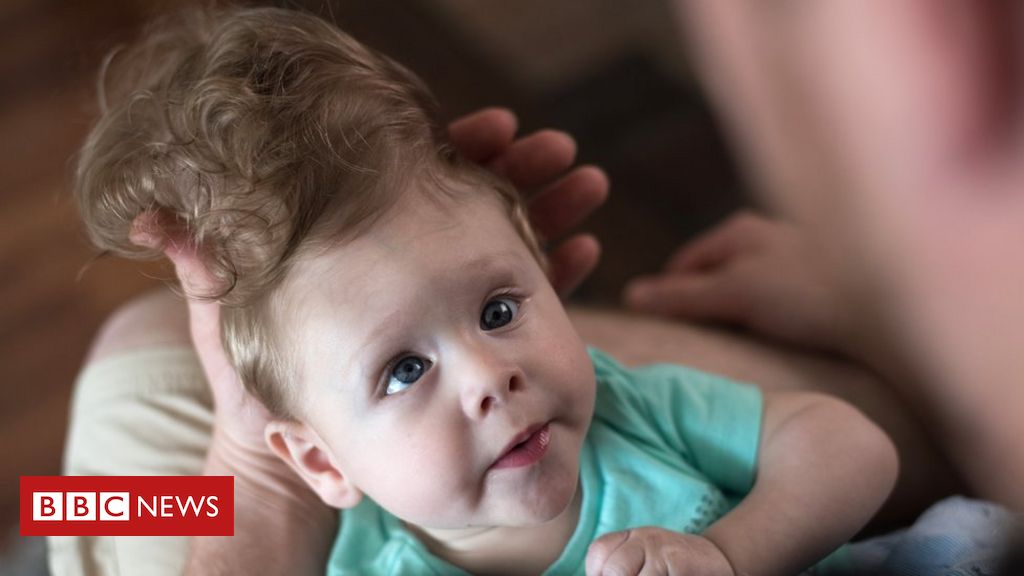 O Bebê Que Surpreendeu Os Médicos Ao Sobreviver Com O Cérebro Fora Do