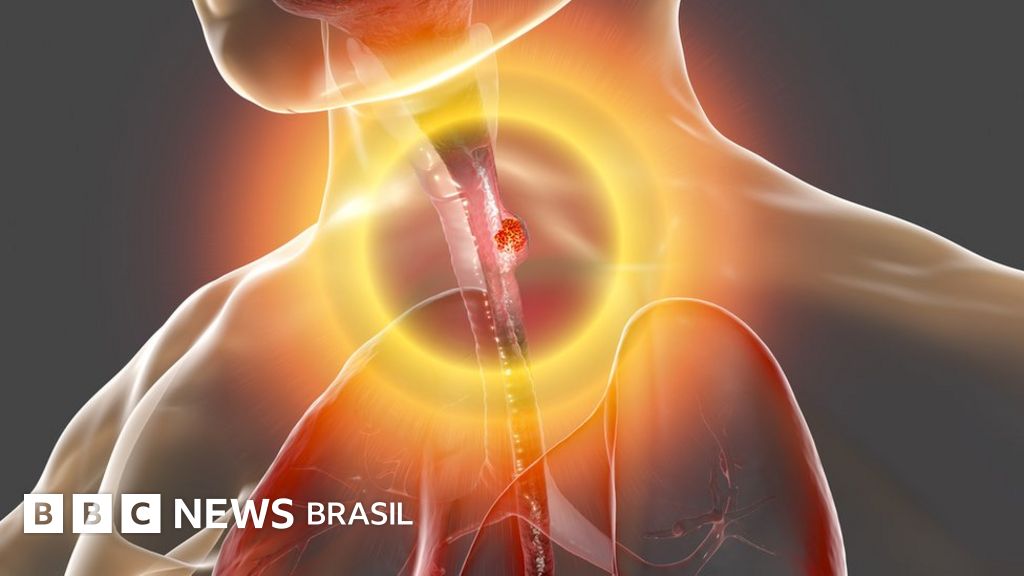 Os sintomas de câncer no esôfago que não devemos ignorar - Blog Cursos ...
