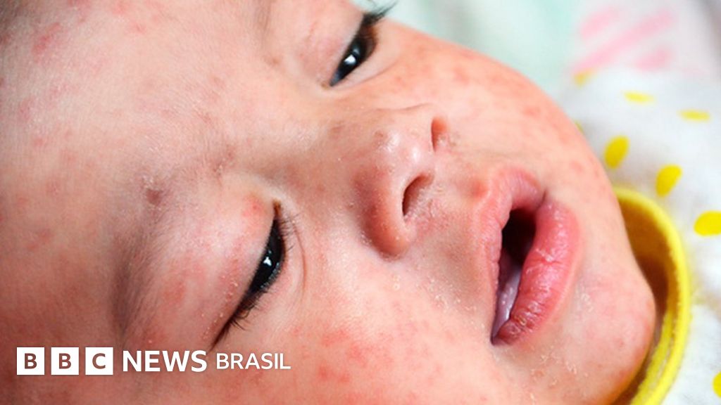 OMS vê ‘tragédia’ em aumento de 400% nos casos de sarampo na Europa ...