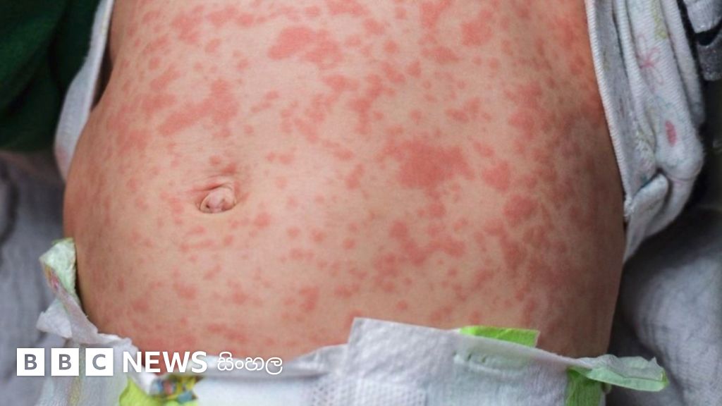 සරම්ප ව්‍යාප්තිය: රෝග ලක්ෂණ සහ MMR එන්නත ආසාදන නතර කරන ආකාරය - BBC News ...