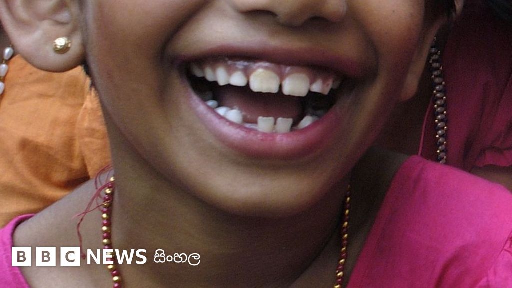 ශ්‍රී ලංකාවේ අවුරුදු පහේ දරුවන්ගෙන් "63%කගේ දත් දිරලා" - BBC News සිංහල