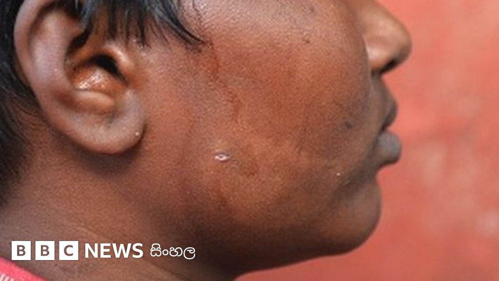 සමේ ලප ගැන දෙවරක් සිතන්න: ශ්‍රී ලංකාවේ ලාදුරු රෝගීන්ගෙන් 10%ක් ළමුන් ...