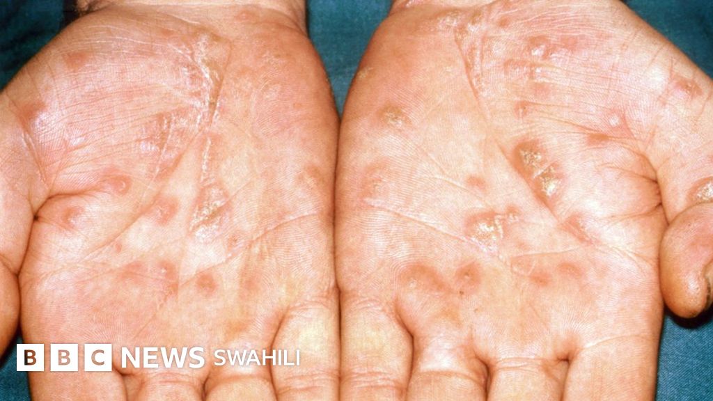 Namna ugonjwa hatari wa kaswende unavyoua watoto Australia - BBC News ...