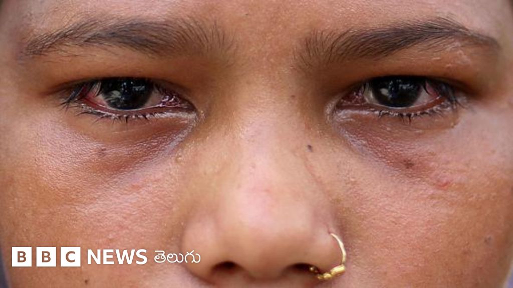 Eye: ఐ ఫ్లూ ఎందుకు వస్తుంది? ఎలా వ్యాపిస్తుంది? - BBC News తెలుగు