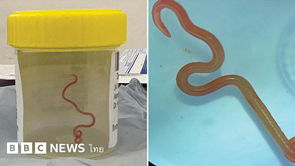 หนอนมีชีวิตที่พบในสมองมนุษย์ครั้งแรกของโลก เป็นโรคระบาดใหม่หรือไม่ ...