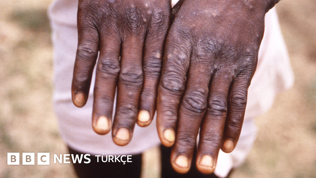 Maymun çiçeği virüsü: 'Kabus değil ama kötü bir rüya olabilir' - BBC ...