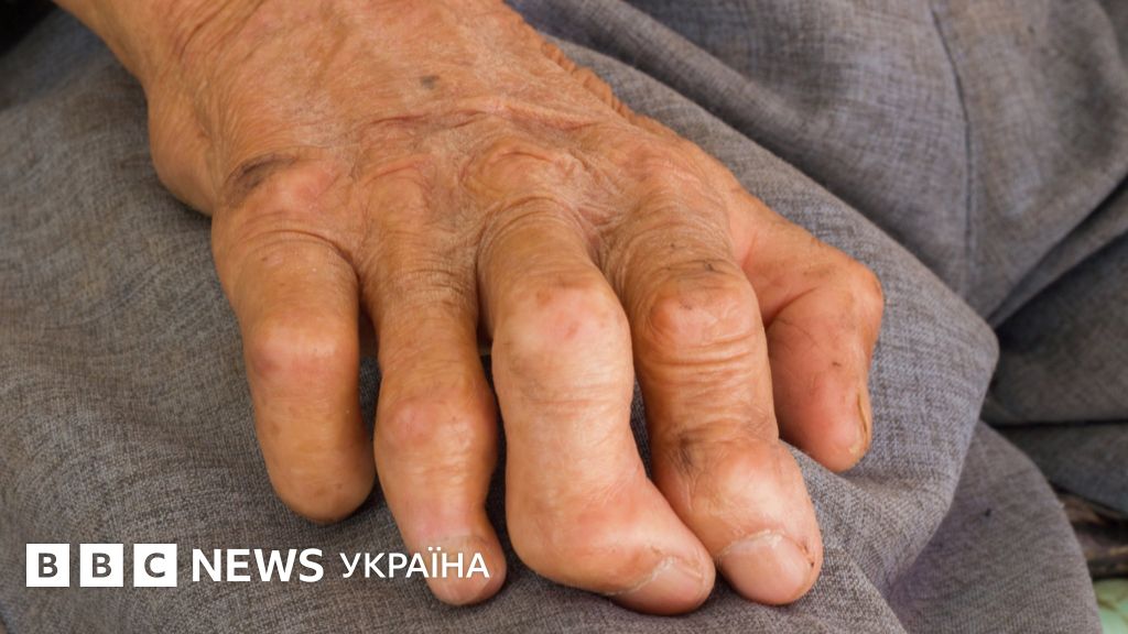 Проказа: давня хвороба, здатна регенерувати органи - BBC News Україна
