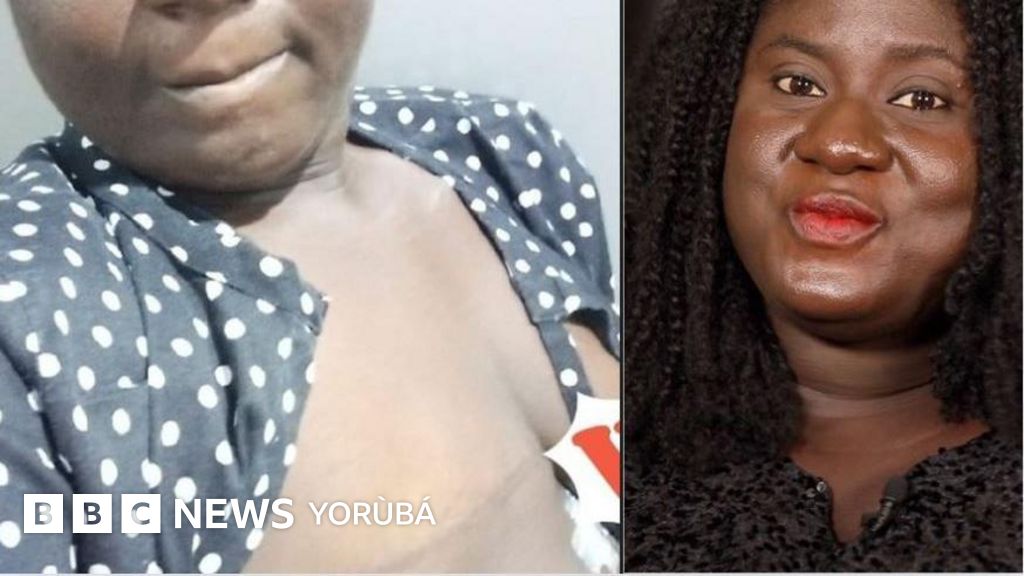 "Jẹjẹrẹ ọyàn mú mi nígbà méjì lẹ́ni ọdún 23, wọ́n fi iṣẹ́ abẹ fá ọmú mi ...