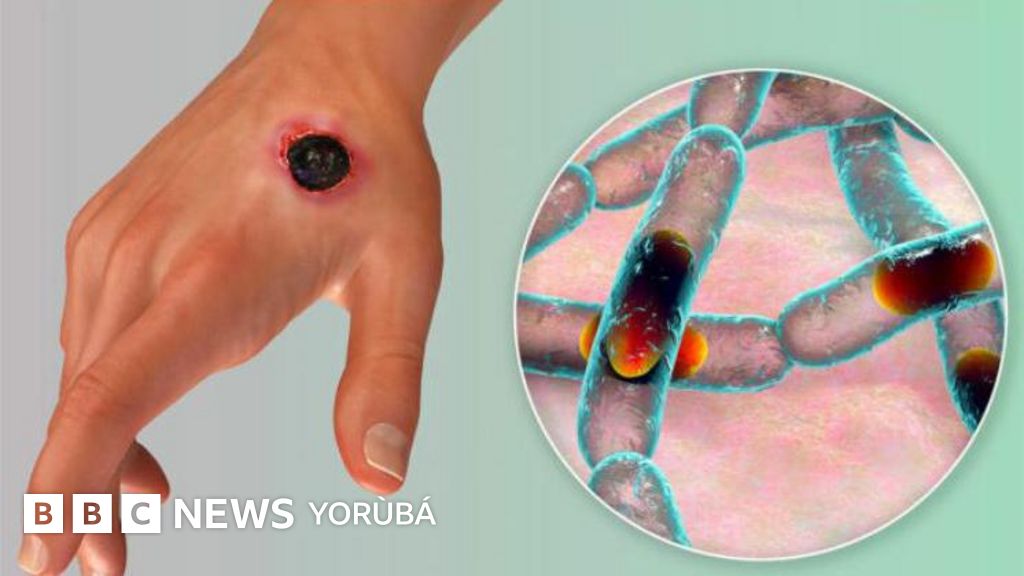 Wo ohun tó yẹ kí o mọ̀ nípa àrùn Anthrax to ṣẹ̀ṣẹ̀ wọ Nàìjíríà - BBC ...