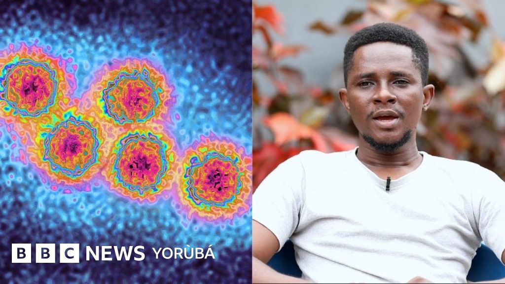 ‘Mo fẹ́ dákú nígbà tí mo gbọ́ pé mo ní àìsàn jẹ̀dọ̀jẹ̀dọ̀ ‘Hepatitis ...