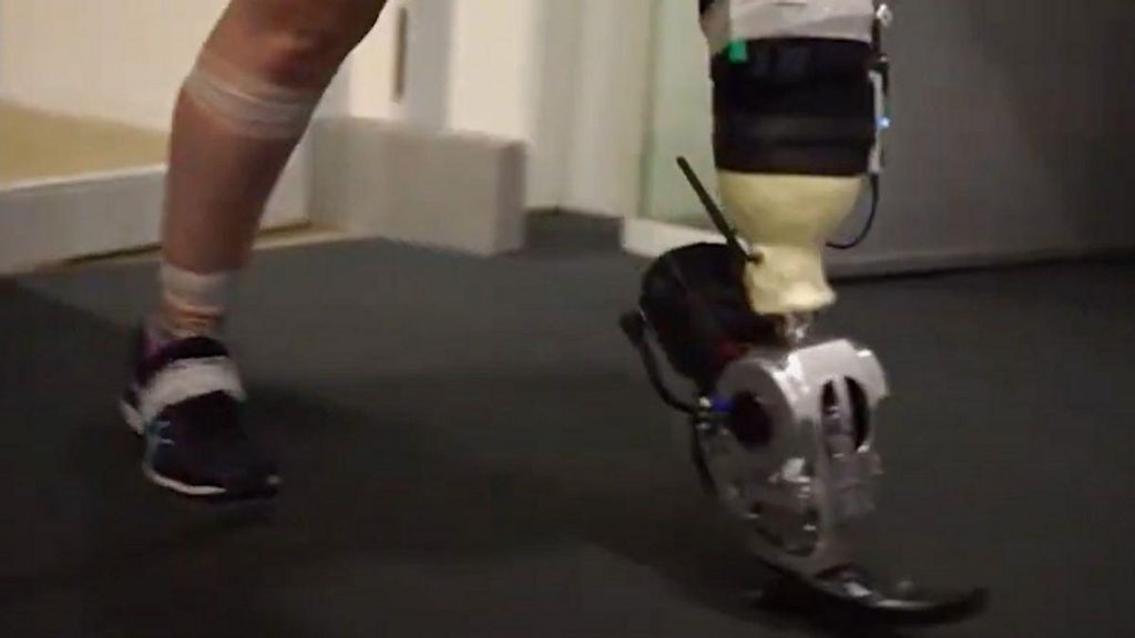 Bionic leg helps amputees walk more naturally - BBC News