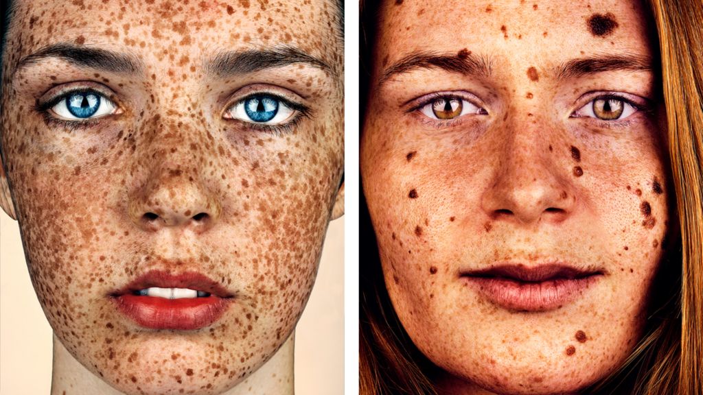 These photos will make you love your freckles - BBC Three