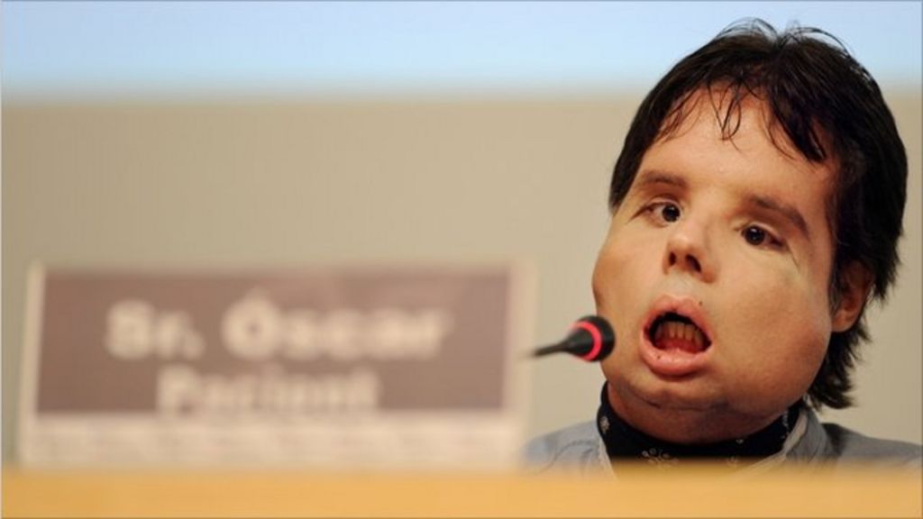 Full face transplant man reveals his new look on TV - BBC News