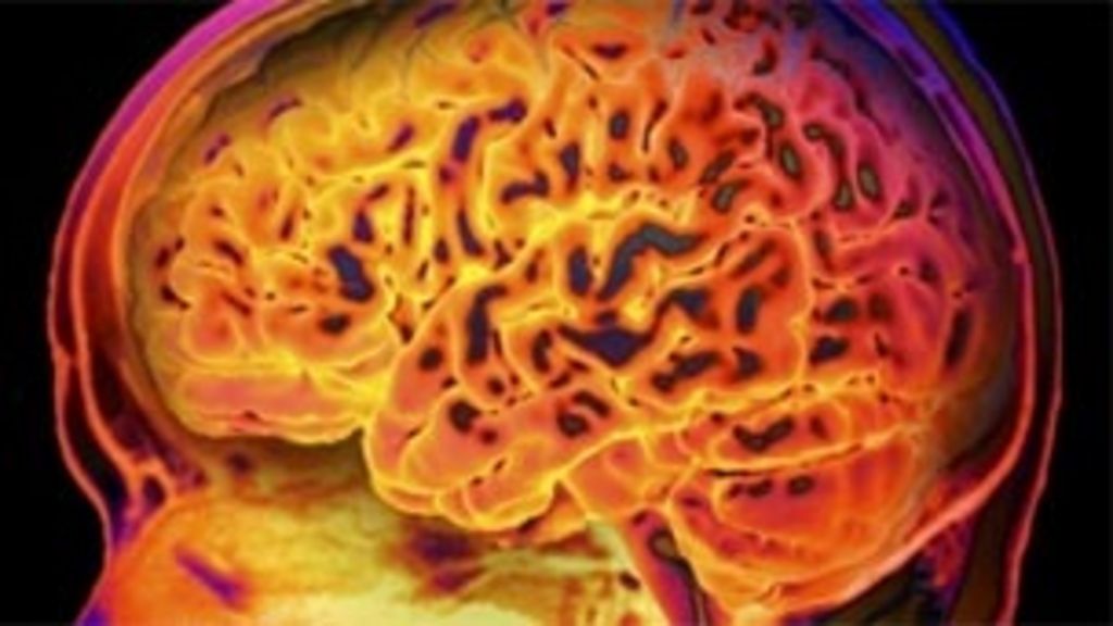 New Brain Scan To Diagnose Autism BBC News new-brain-scan-to-diagnose-autism-bbc-news