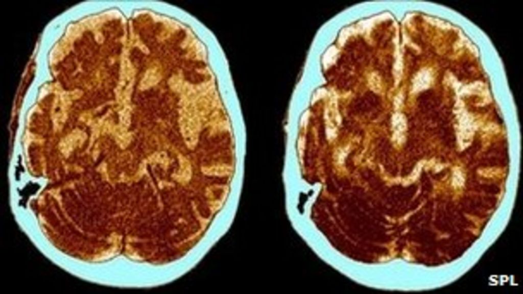 Q&A: Alzheimer's drug guidelines - BBC News