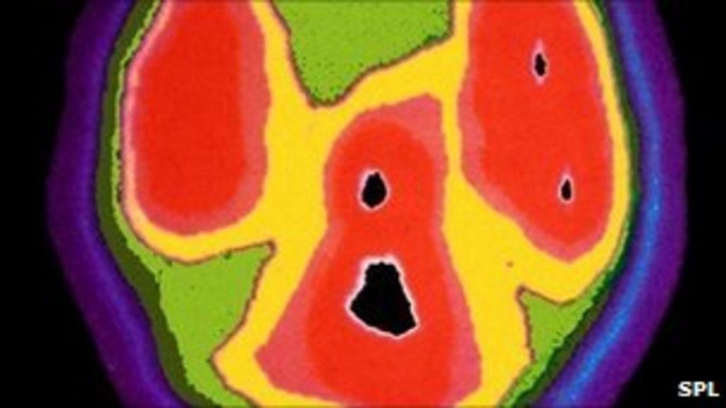 Autism brain secrets revealed by scan - BBC News