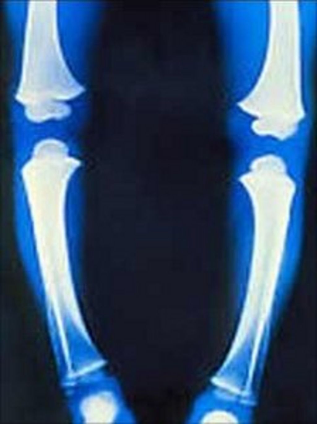 Increase in rickets in Southampton astonishes doctors - BBC News