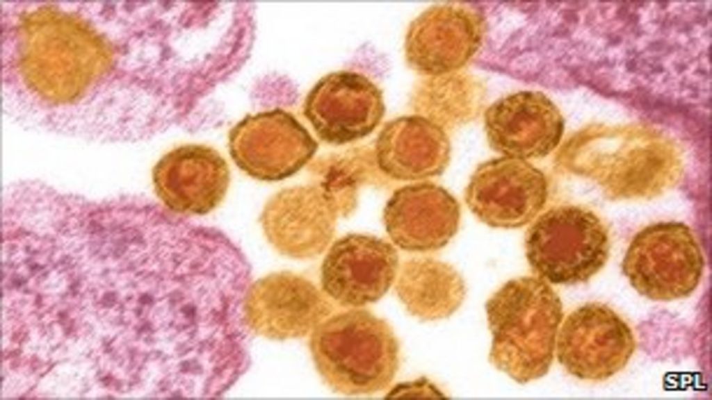 ME, or chronic fatigue syndrome, 'not caused by the XMRV virus', say ...