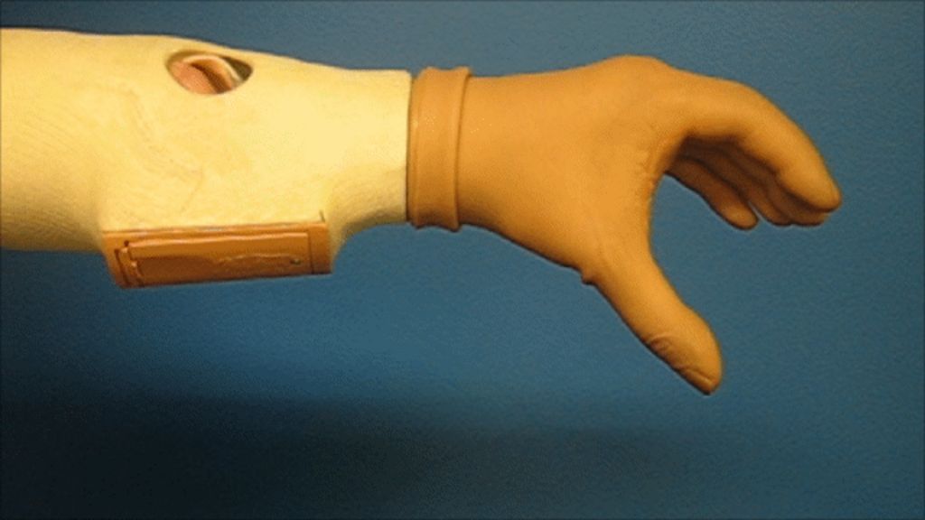 Man opts for amputation and bionic replacement - BBC News