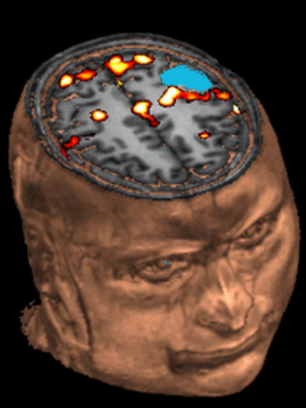Coma brain image techniques being developed in Aberdeen - BBC News