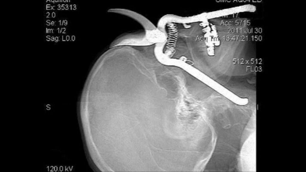 Man, 86, survives shears impaling his eye socket - BBC News