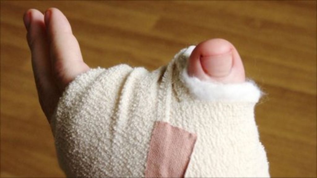 Man who severed thumb has big toe attached in its place - BBC News
