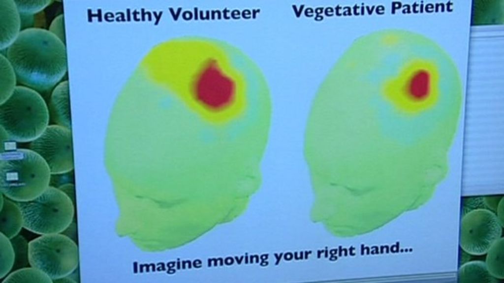 New way to communicate with brain damaged patients - BBC News