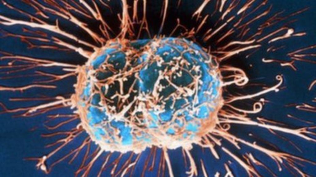 Cervical Cancer Screening One In Four In Wales Miss Test Bbc News