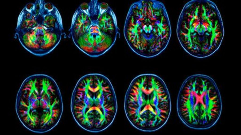 Web addicts have brain changes, research suggests - BBC News