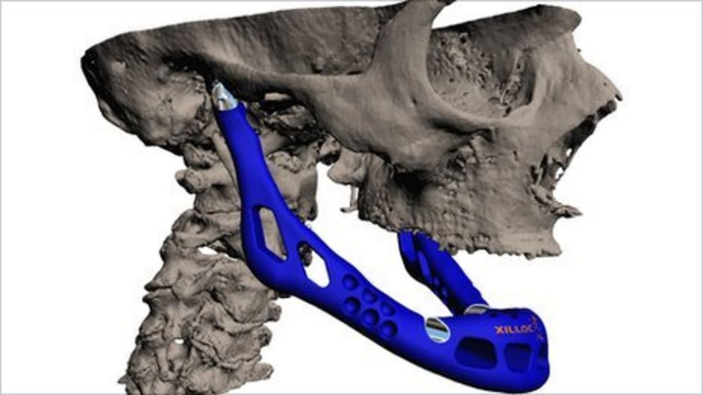 Transplant jaw made by 3D printer claimed as first - BBC News