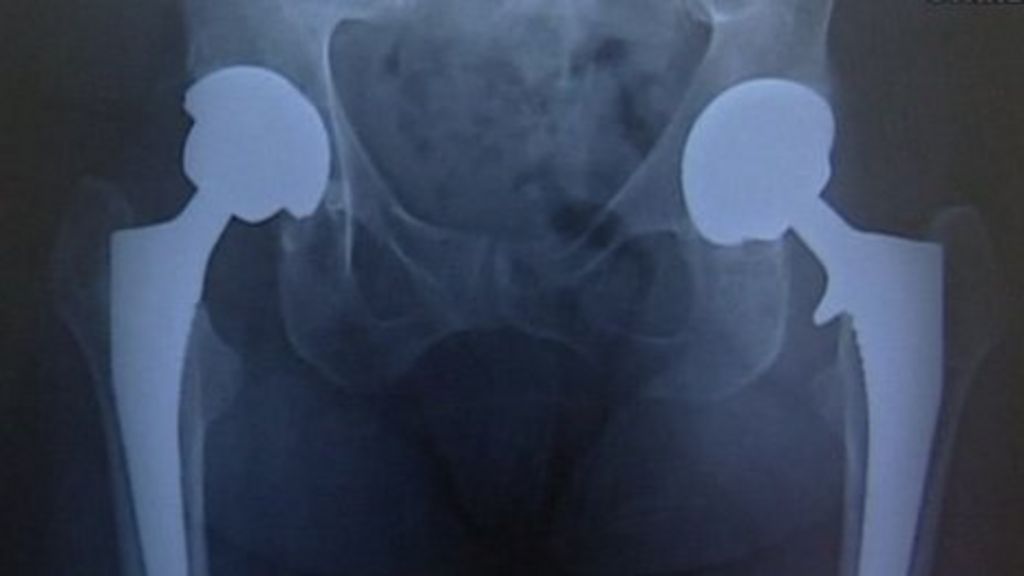 MHRA: Metal hip implant patients need life-long checks - BBC News