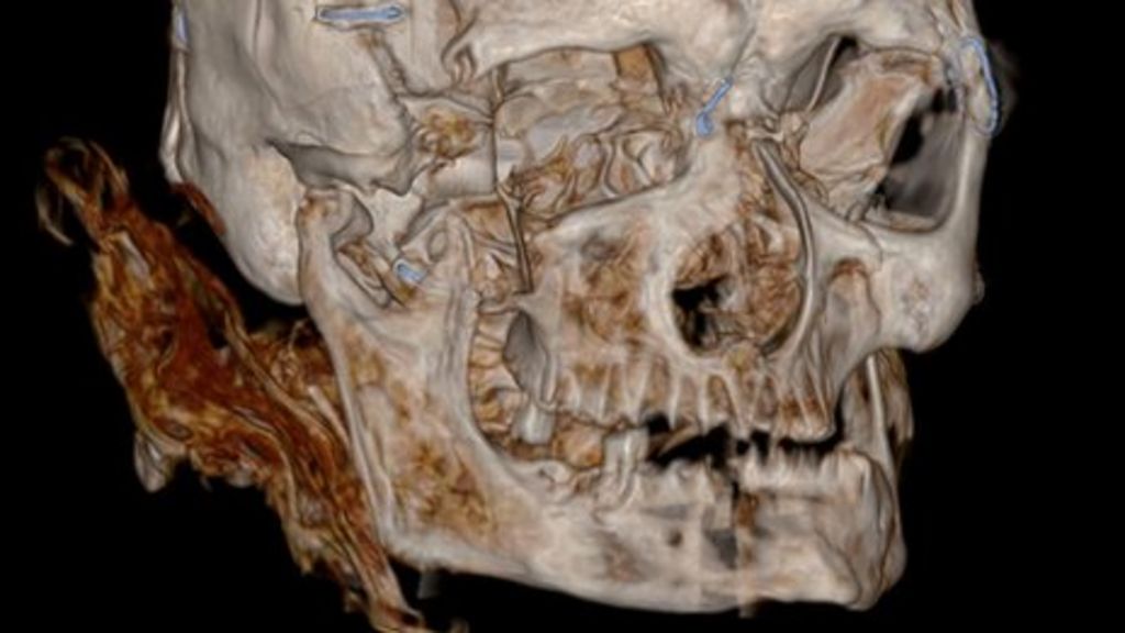 Worsley Man: Hospital scanner probes Iron Age bog death - BBC News