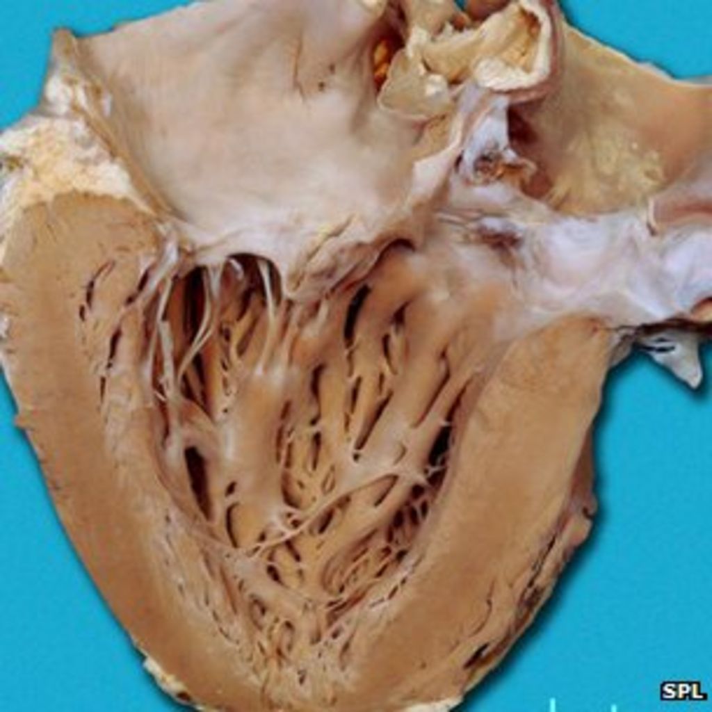 Screening clinic shows "huge promise" for hidden heart problems - BBC News