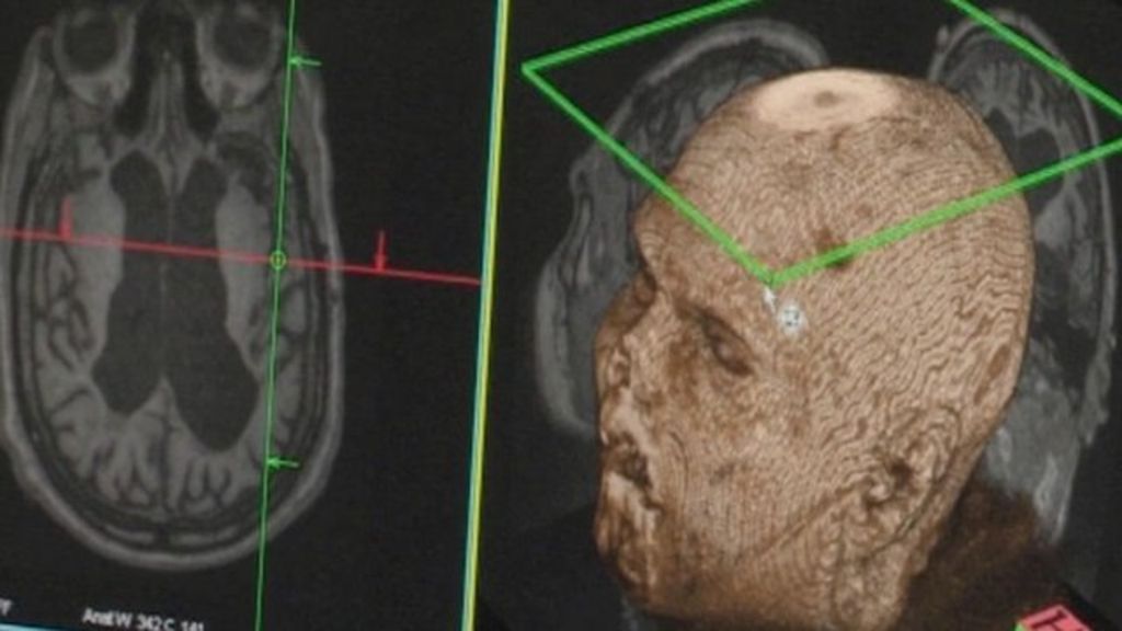 Vegetative patient 'speaks' to doctors through scanner - BBC News