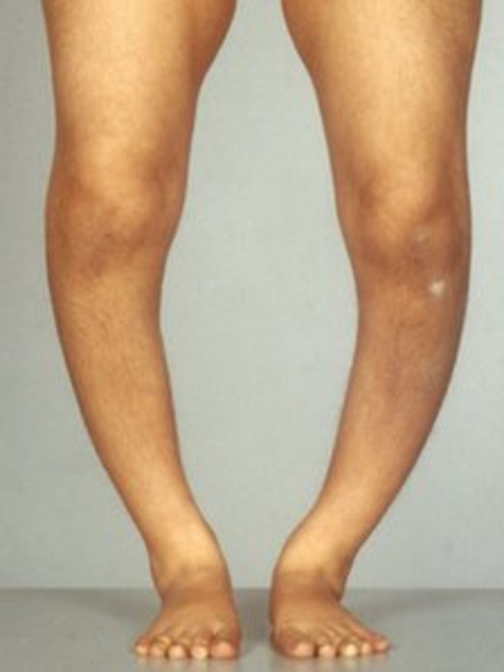Cheap Vitamin D would Boost Health BBC News Cheap Vitamin D would Boost Health BBC News