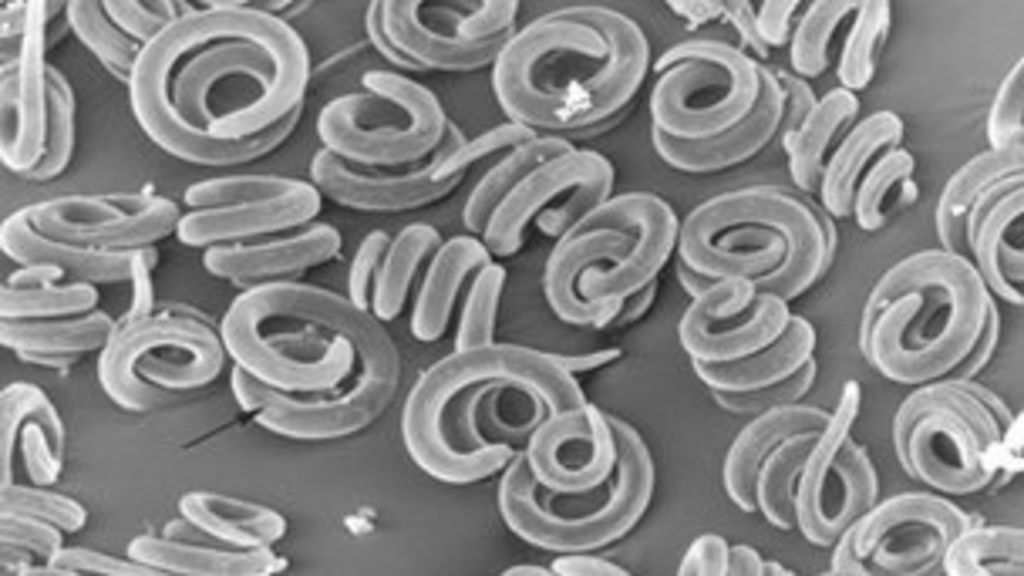 Weight loss 'is body's way of fighting off gut worms' - BBC News