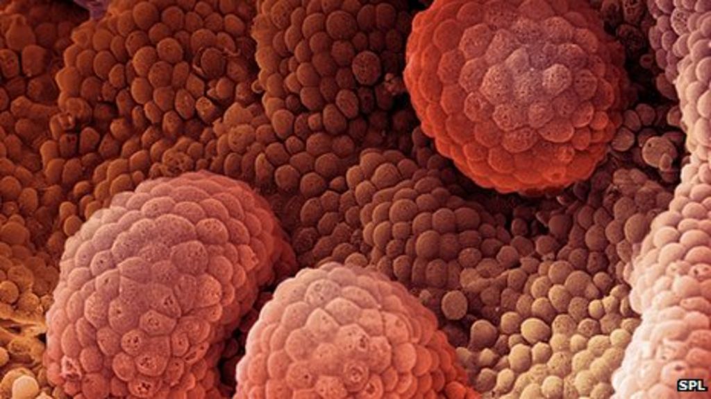 Skin patches 'tackle prostate cancer' - BBC News