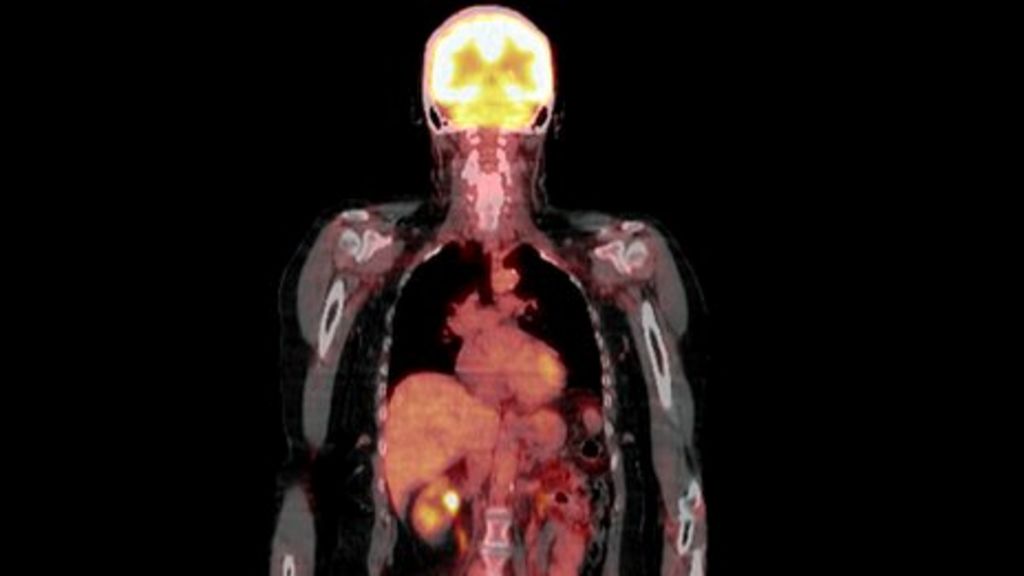 Imaging 'promises pinpoint cancer treatment' - BBC News