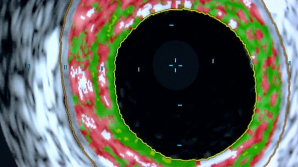 New way to detect heart attack risk - BBC News