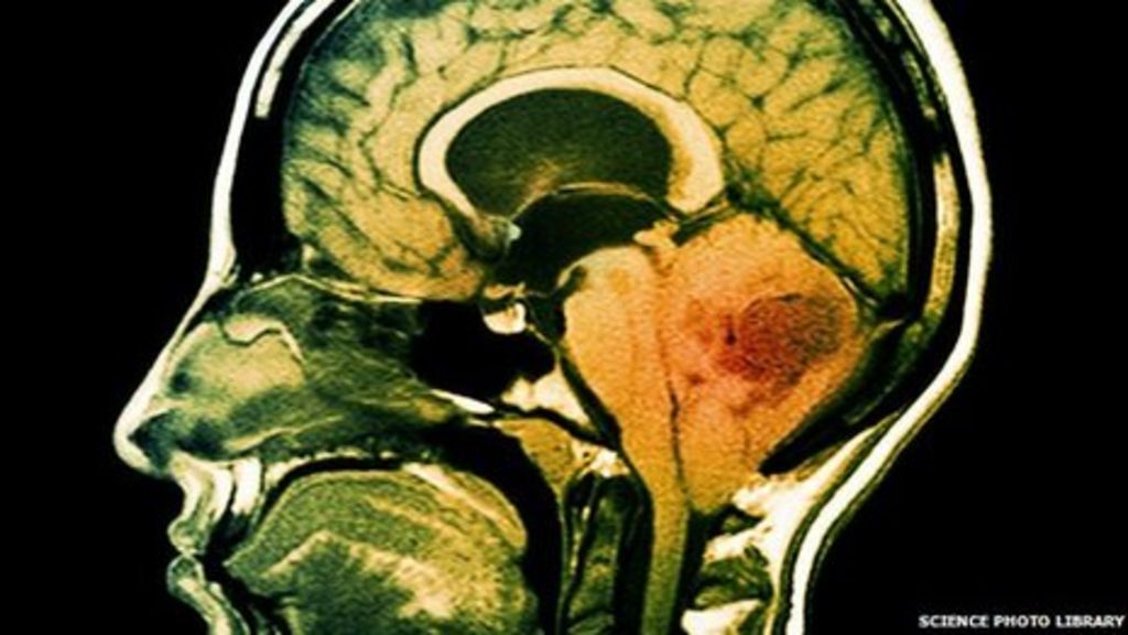 Virus injection could kill brain tumour cells - BBC News