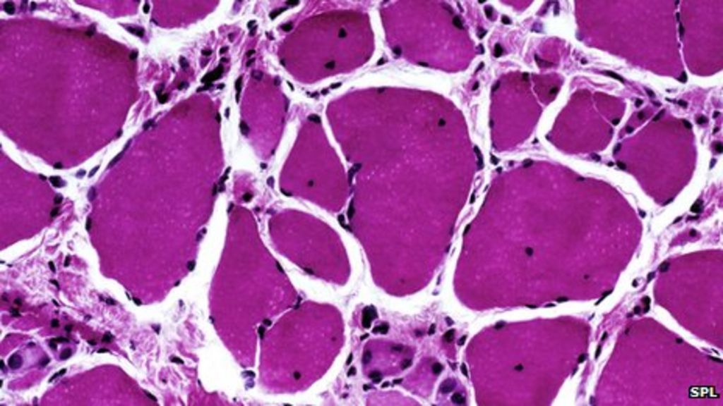 MPs call for newborn muscular dystrophy test - BBC News