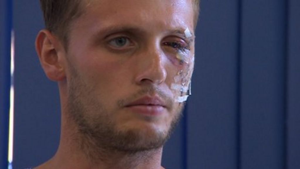 Hanham Athletic footballer victim of 'glassing' - BBC News